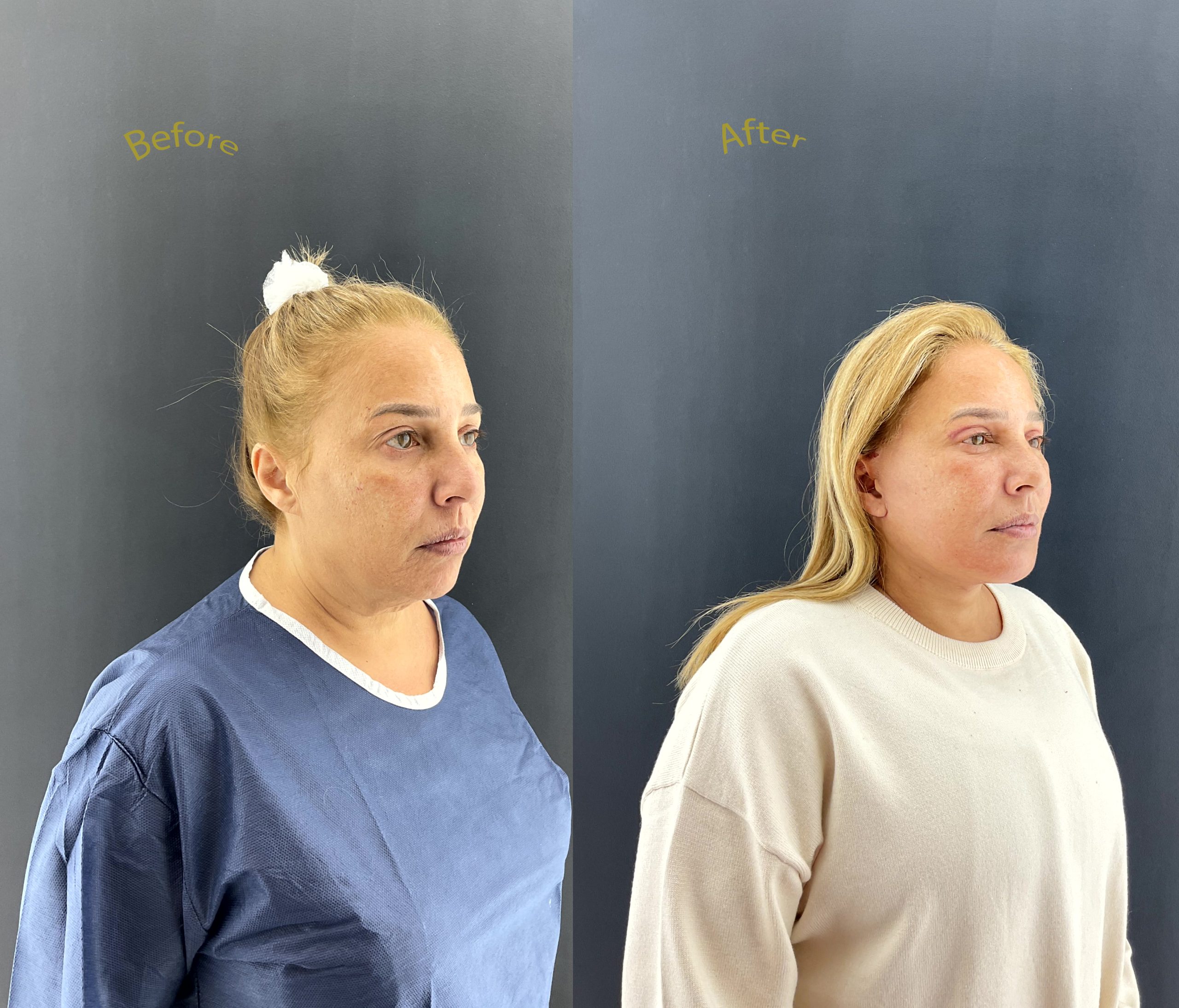 DEEP PLANE FACE & NECKLIFT, PLATYSMAPLASTY AND CHIN IMPLANT ΥΠΟ ΤΟΠΙΚΗ ...